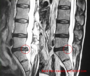 Decompression Therapy Treatment in San Mateo - Bella Vita Chiropractic ...